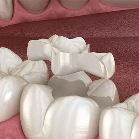 Composites Inlays and Onlays | Brilliant Smiles Of Hollywood
